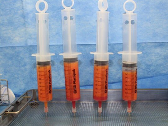 Lipofilling - ETHIANUM Klinik Heidelberg | Chirurgie auf höchstem Niveau